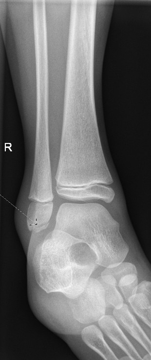 Fractures - Ankle