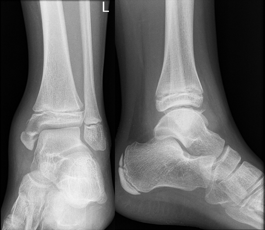 Fractures - Ankle